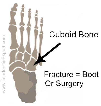 Cuboid Bone Sharp Pains